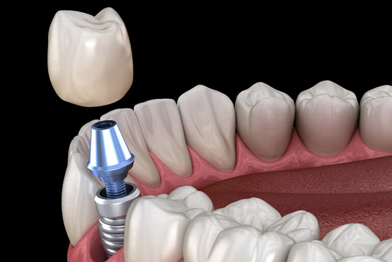 Bonvallet Dental | Dentist | Byron, IL | Pecatonica, IL